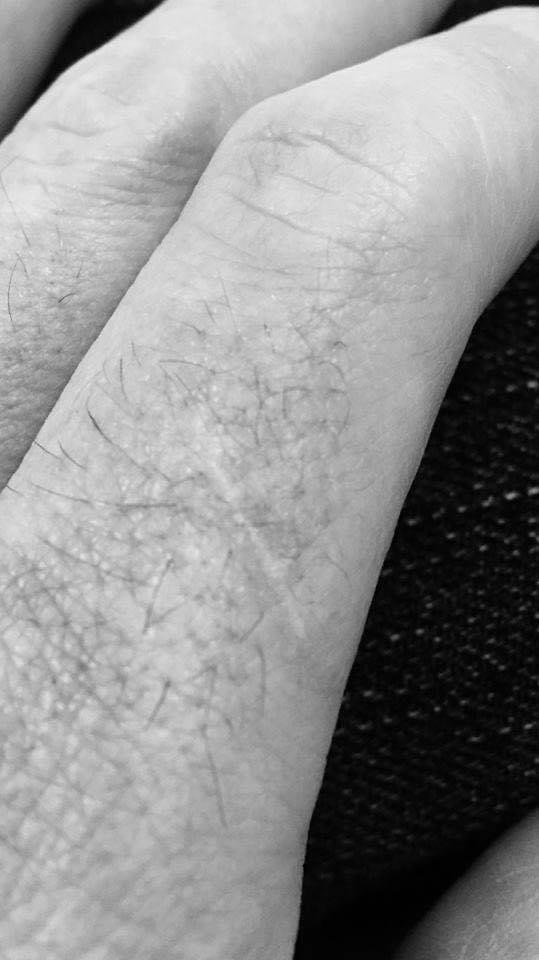 A Scar – DocBott